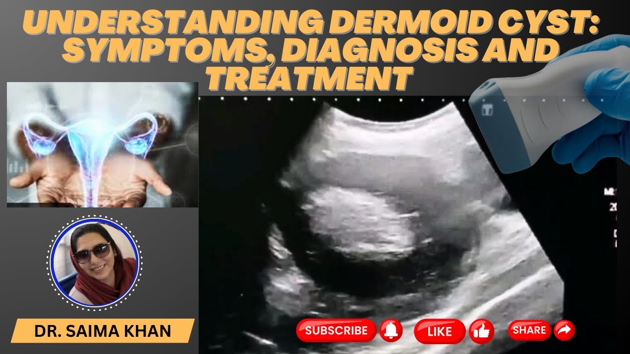 Understanding Dermoid Cyst: Symptoms, Diagnosis and Treatment # ...