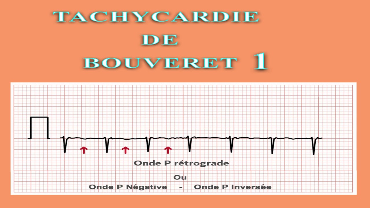 ECG Interpretation tres facile de l ECG 11eme partie TSV Tachycardie ...