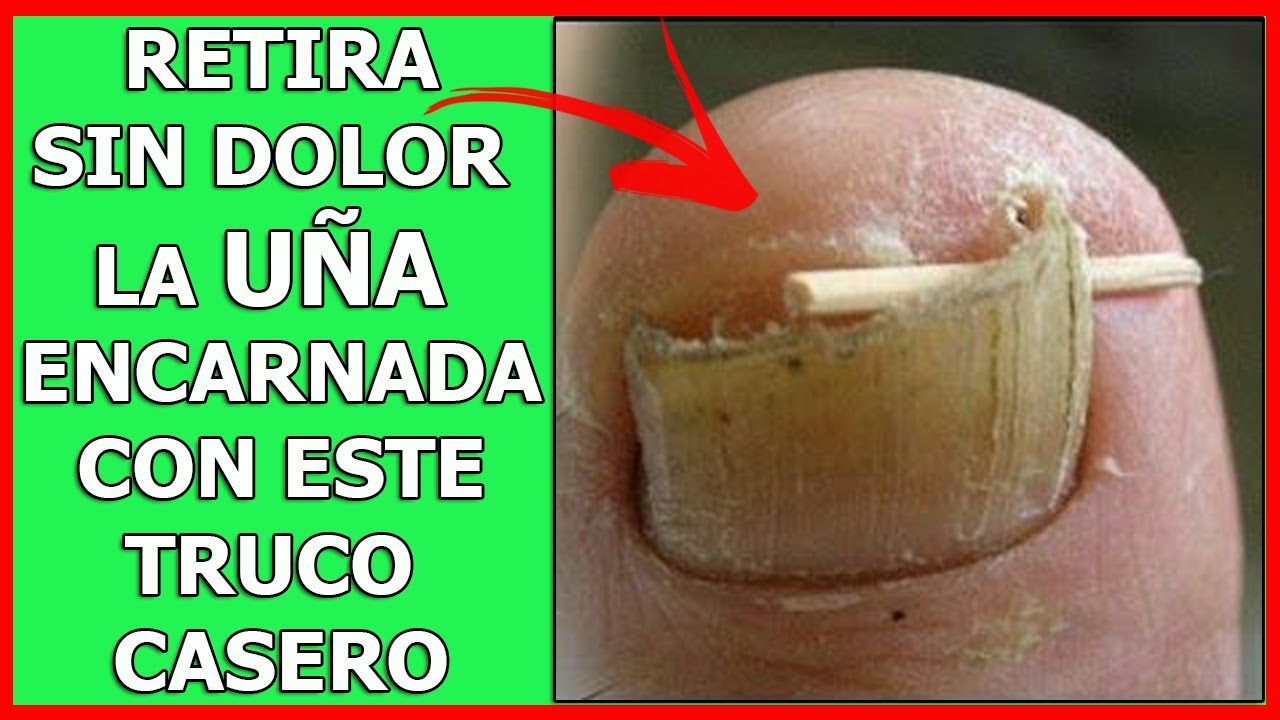 Este TRUCO eliminó el UÑERO que tenía sin Dolor😩 Saca las Uñas ...