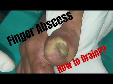Finger infection| Drainage of pulp space abscess| How to drain pus from ...