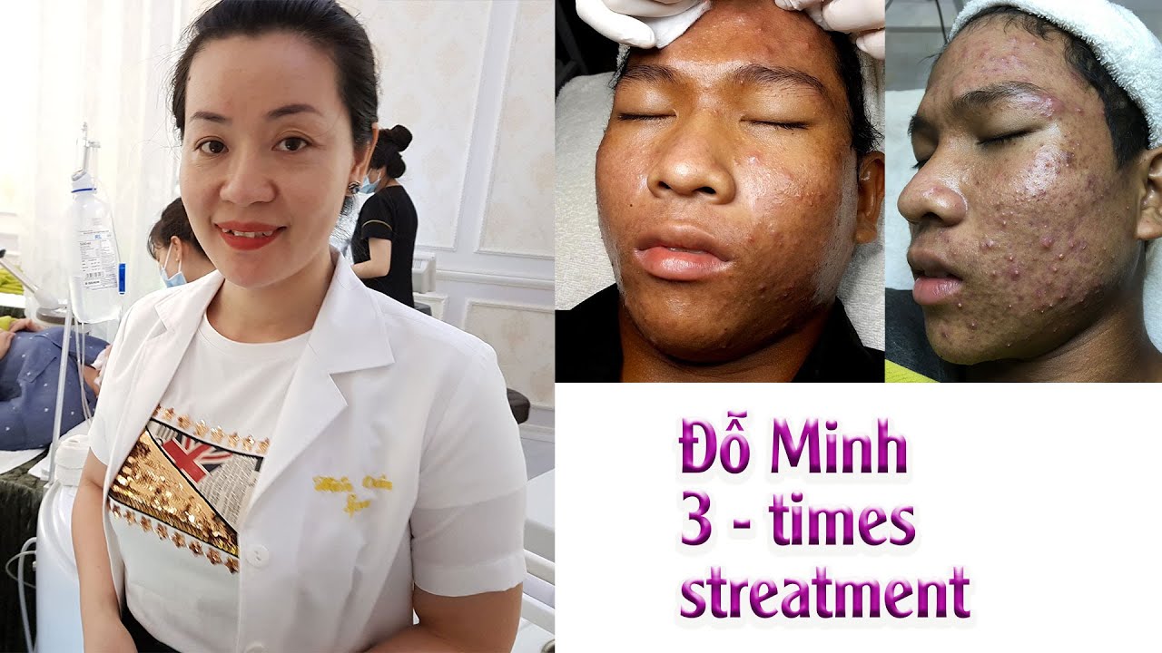 Acne treatment reputation, effective at Hien Van Spa|375|Đỗ Minh-3 ...