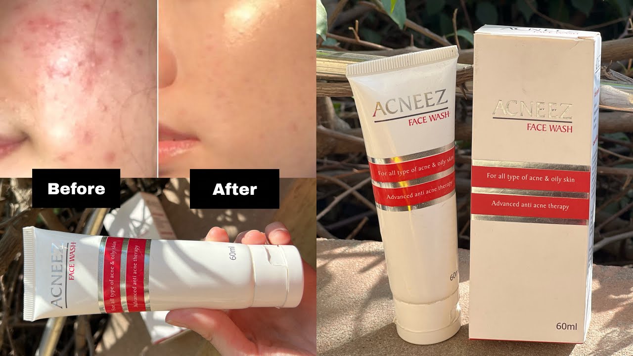 How to Remove, Reduce Acne /Acneez Face Wash Honest Reviews / How to ...