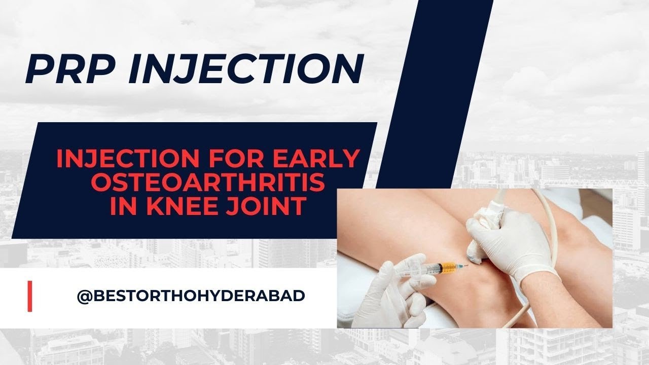 PRP( PLATELET RICH PLASMA) INJECTION FOR EARLY OSTEOARTHRITIS IN KNEE ...
