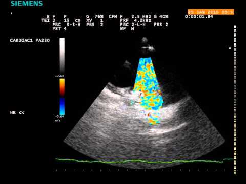 PDA parasternal short axis view - YouTube