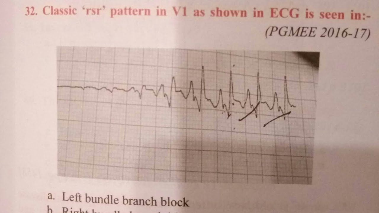 Cardiology neet pg 2019 exam image based mcq - YouTube