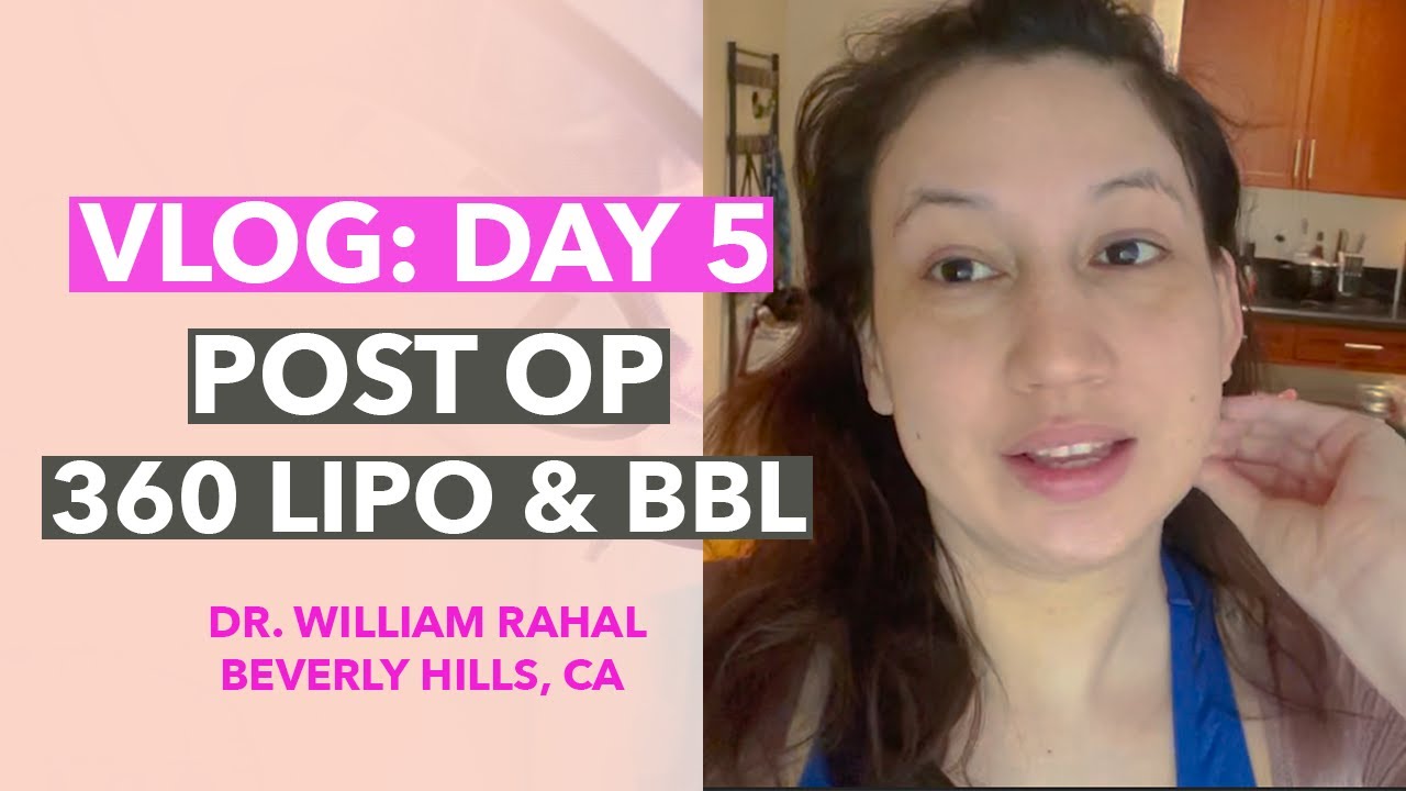 VLOG: Day 5 Post-Op Brazilian Butt Lift and 360 Lipo Before and After ...