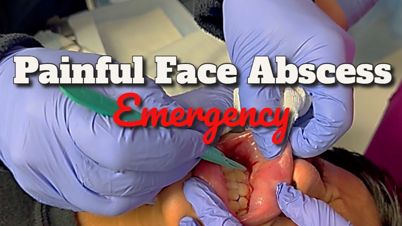 We Drain a Painful Facial Abscess in a Teenager - YouTube