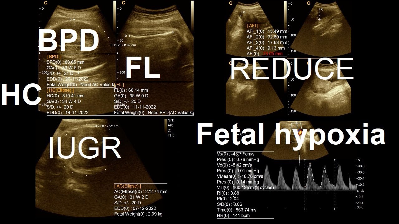 Doppler study || Fetal hypoxia || IUGR || Ultrasound || Report ...