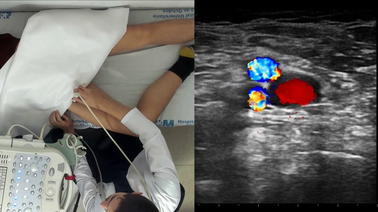 Habilidades prácticas ECOE 5° - Ecografía de TVP - YouTube