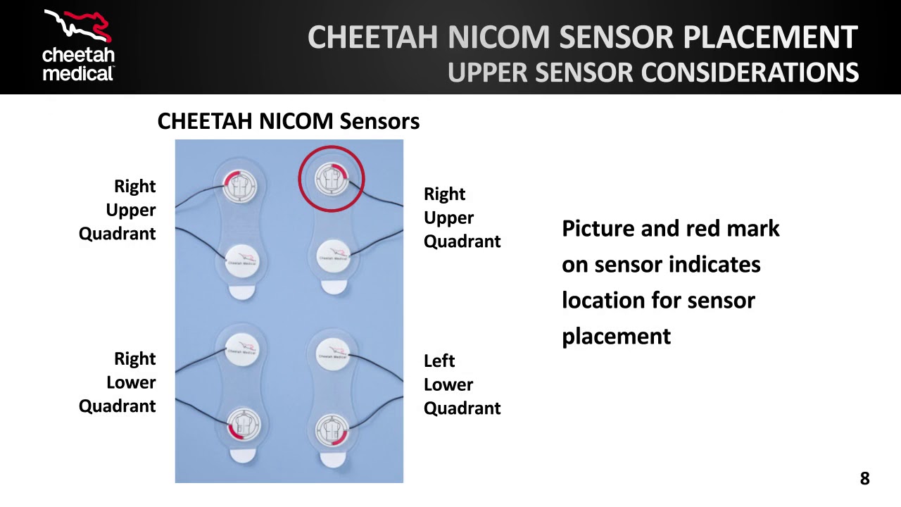CHEETAH NICOM™ Sensor Placement - YouTube
