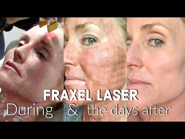My FRACTIONAL CO2 LASER Experience The FULL Treatment the DAYS following BEFORE AFTER Fraxel YouTube