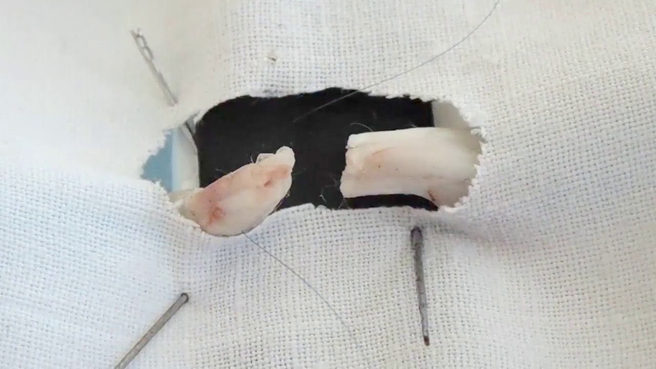 Cuneo tendon suture - YouTube