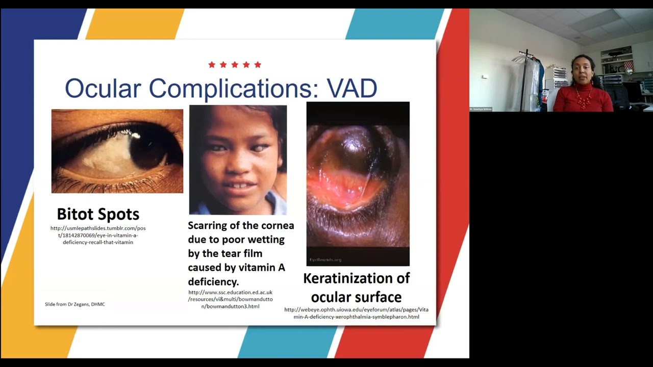 Vitamin A Deficiency Eye