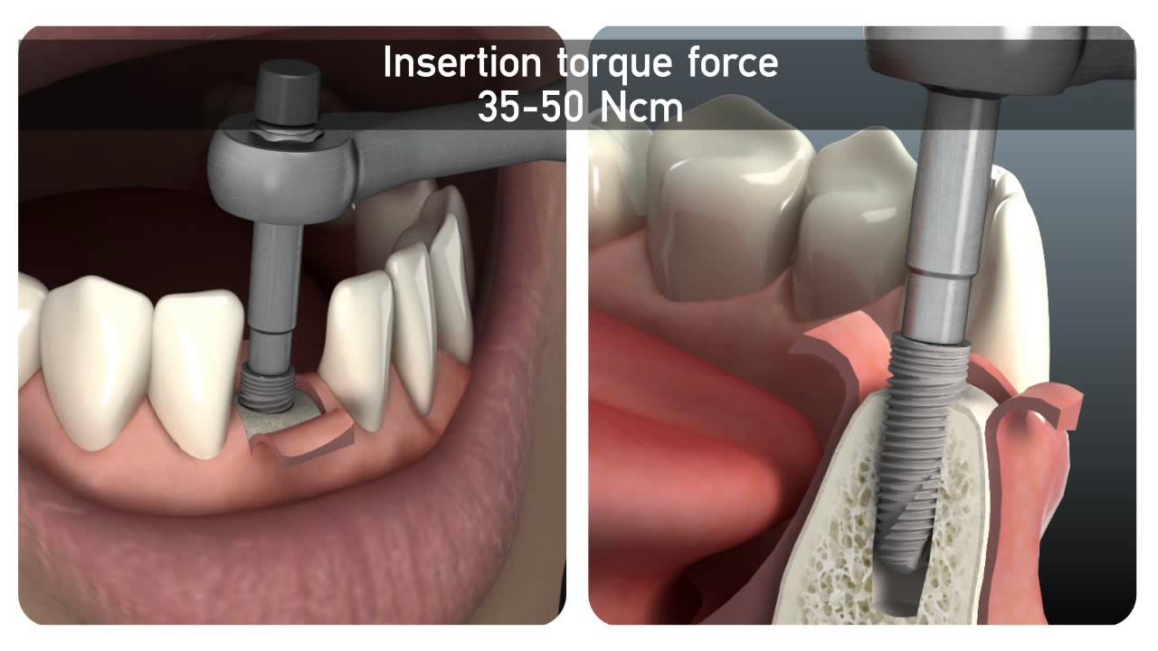 video 1 Donja vilica - YouTube