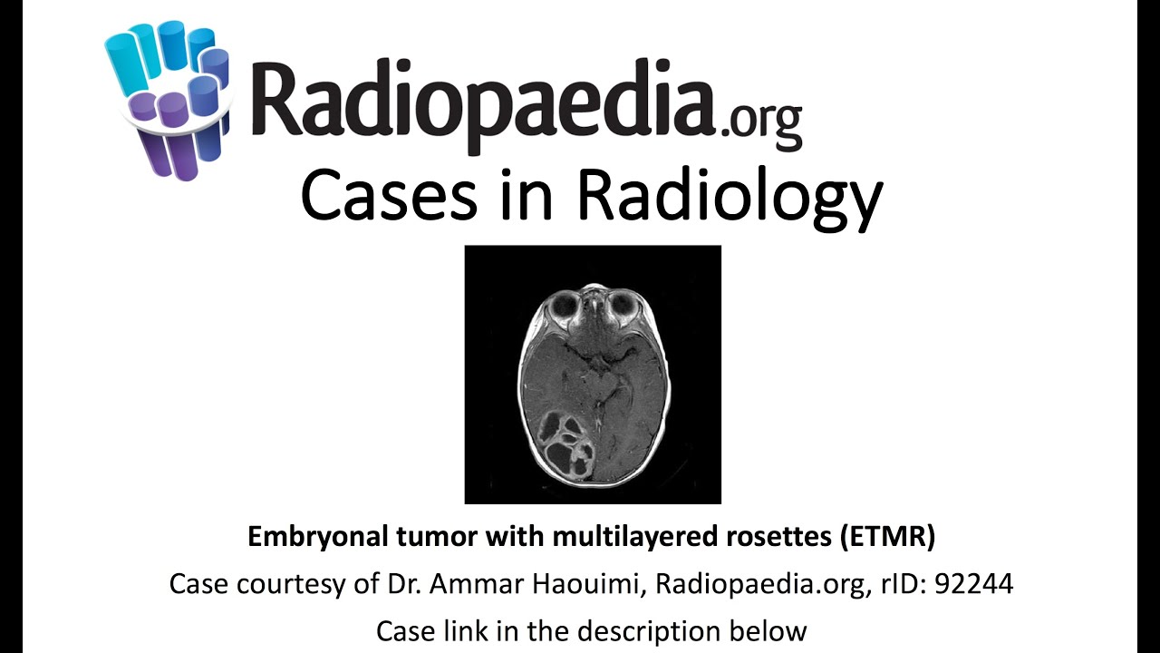 Embryonal tumor with multilayered rosettes (ETMR) (Radiopaedia.org ...