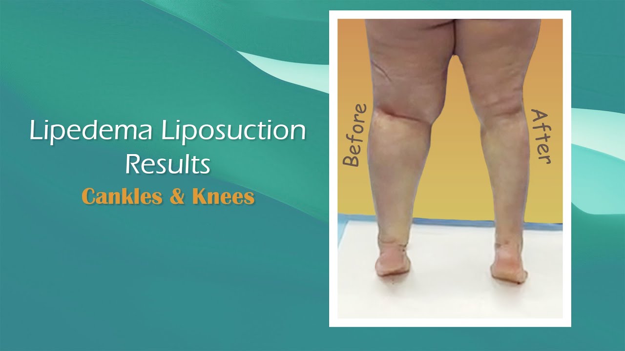 Lipedema Leg Liposuction | Expert Dr. Thomas Su - YouTube