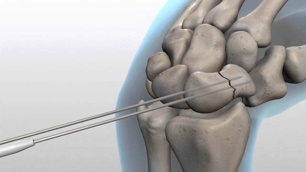 Trauma Solutions - Acumed Surgical Technique - YouTube