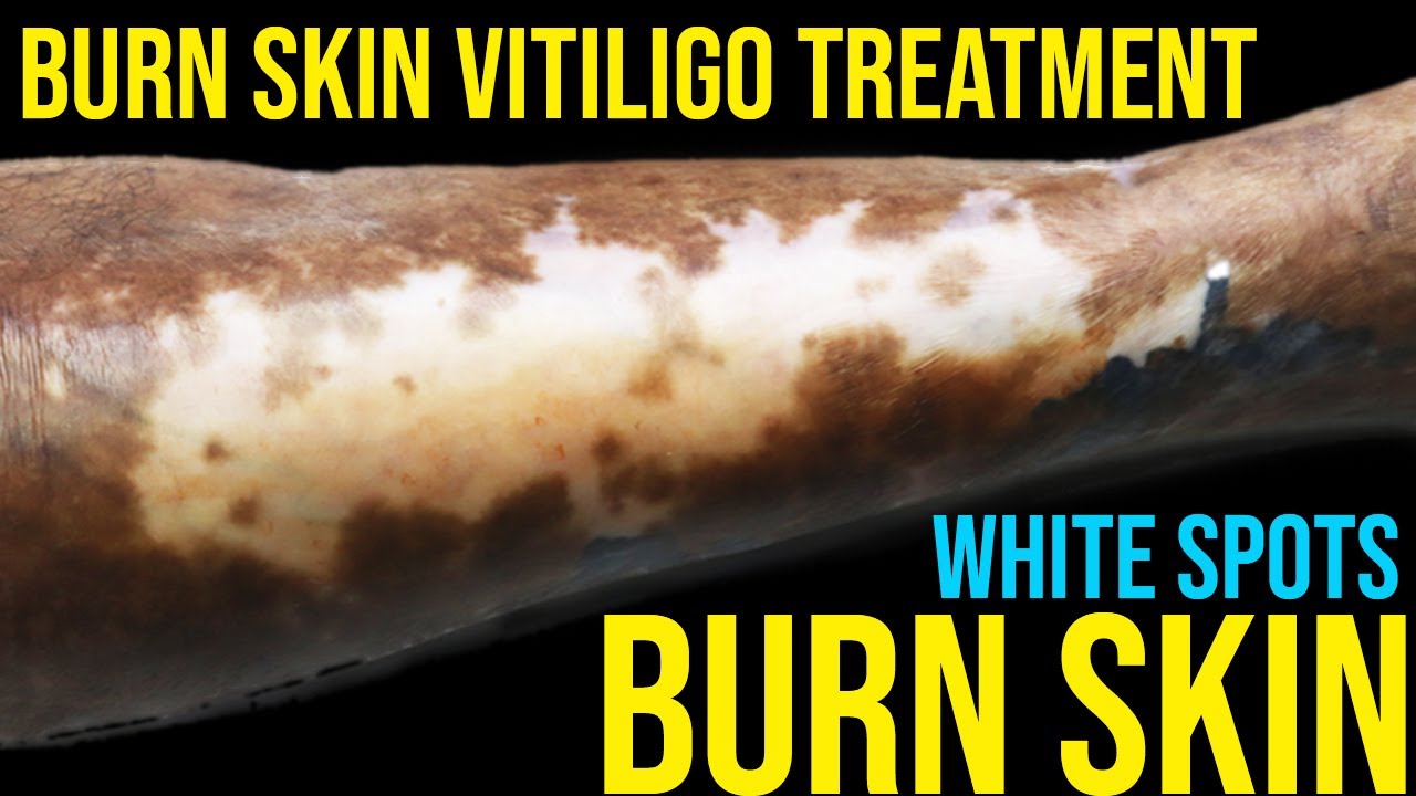 Burn Skin White Spots Vitiligo Treatment - Safed daag ka Ilaaj ...