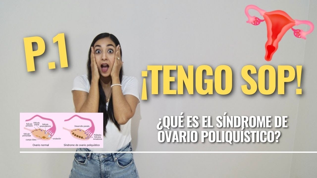 ¡TENGO SOP! ¿Qué es el síndrome de ovario poliquístico? - YouTube
