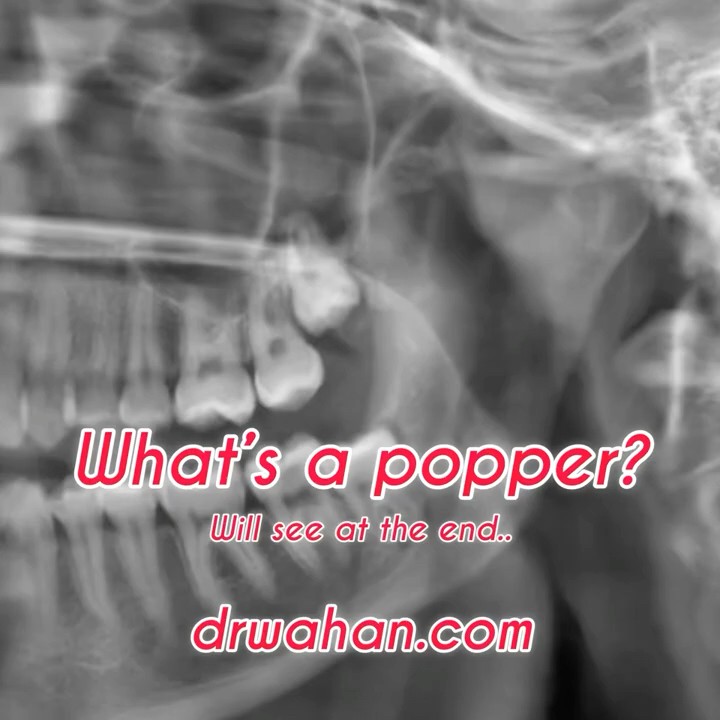 Wisdom Tooth Pops Out - YouTube