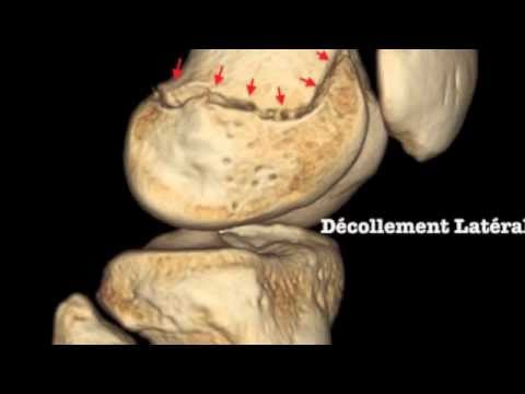 Decollement Périosté du Fémur en scanner 3D - YouTube