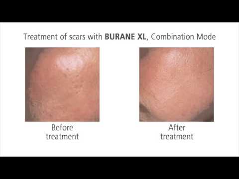 BURANE, plataforma monotecnología ER:YAG de Alma Lasers - YouTube