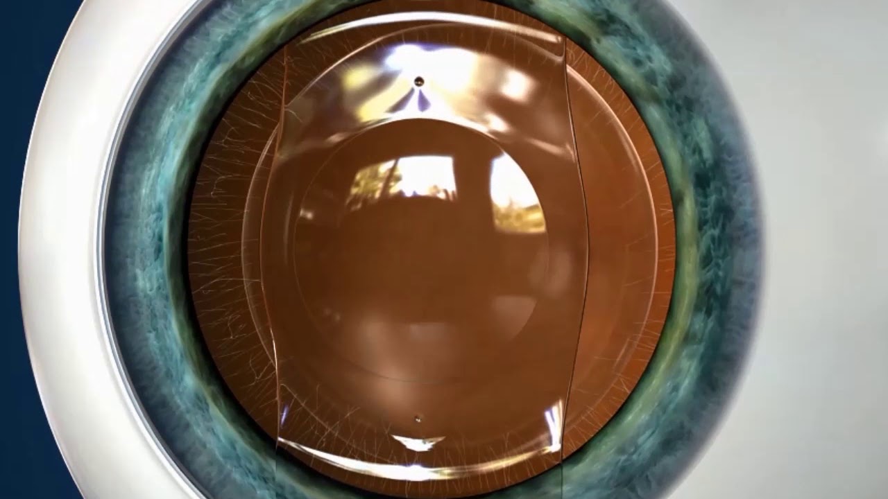 Visian ICL Procedure Video - YouTube