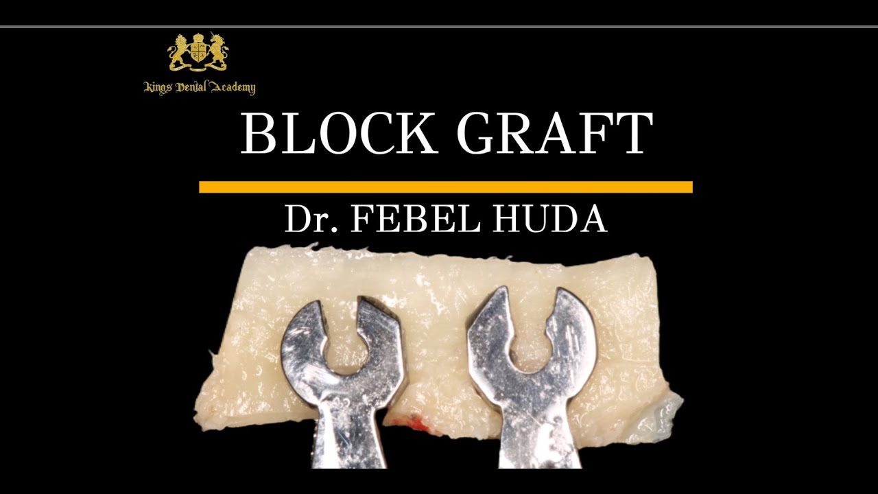 BLOCK GRAFT HARVESTED FROM BODY OF MANDIBLE - YouTube