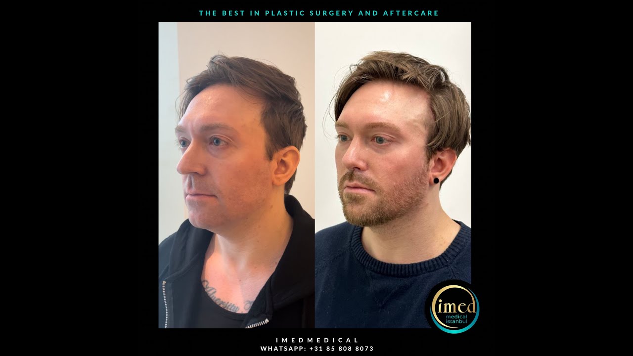 CHECK THE DIFFERENCE (before after) result mid facelift men imedmedical ...