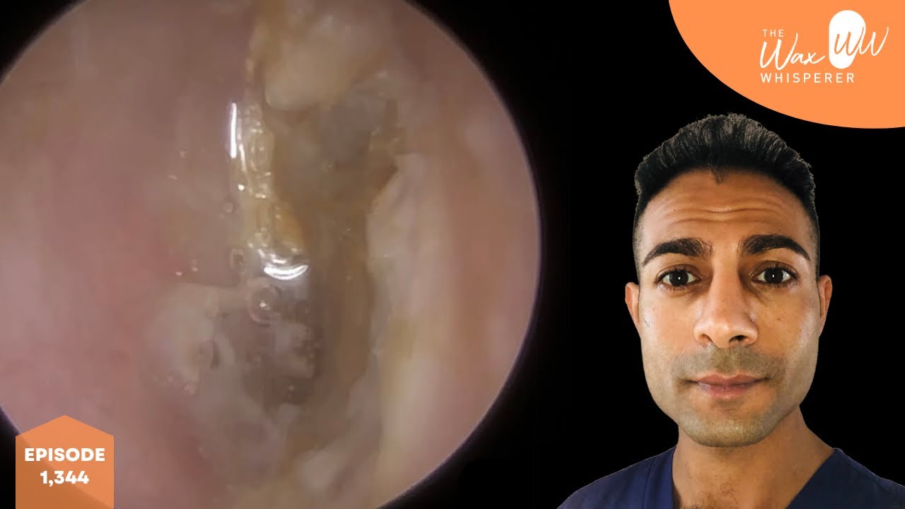 1,344 - Rare 1 in 1000 Ear Pathology Revealed Post Ear Cleaning ...