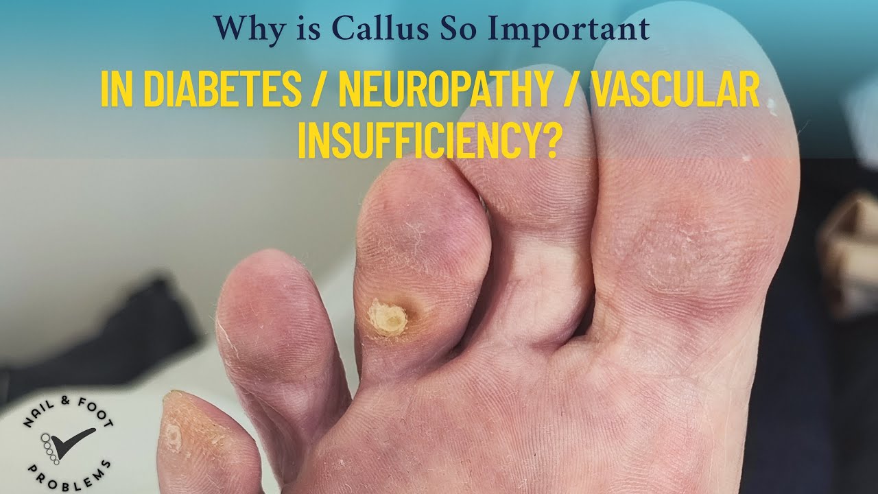 Diabetes-Neuropathy-Vascular Insufficiency-Callus And Corn-Podology ...