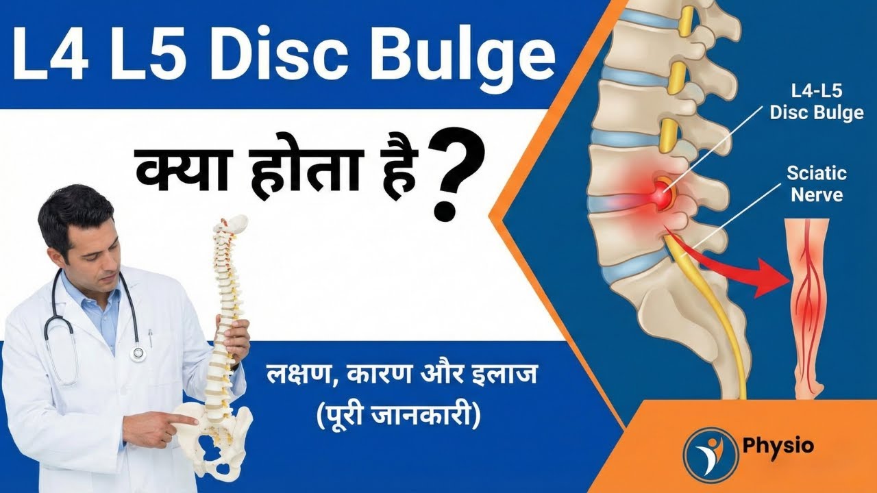 L4-L5 Disc Bulge क्या होता है? | Symptoms, Causes & Treatment in Hindi ...