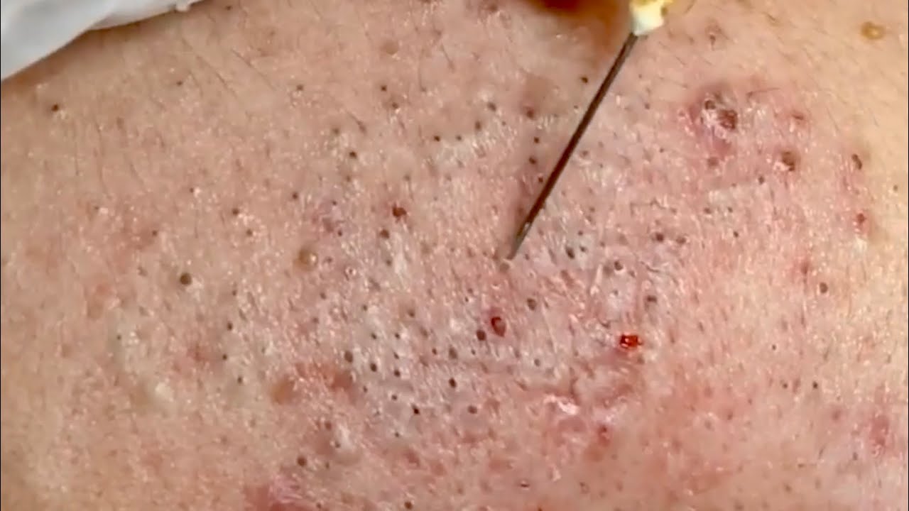 Pimple Popping 2020 Video Blackheads Extraction Blackheads Removal Pimple Popping 2020 Video Blackheads Extraction Blackheads Removal