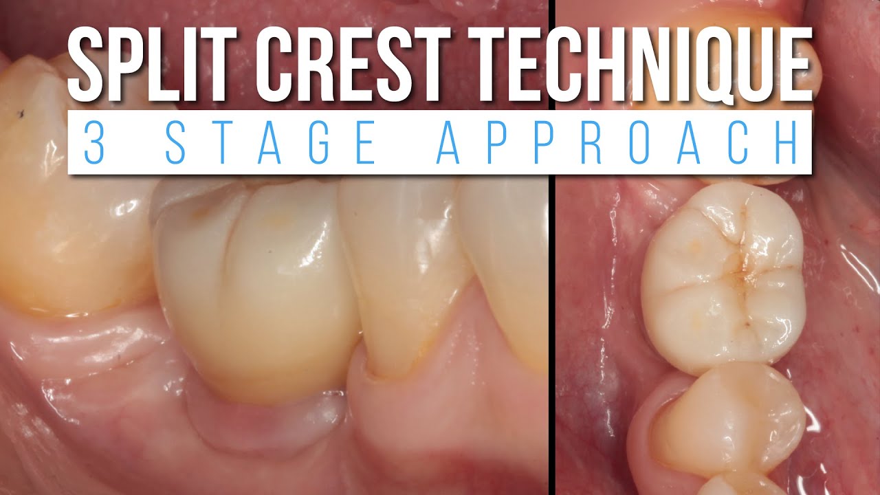 Split Crest Technique - 3 stage approach - YouTube