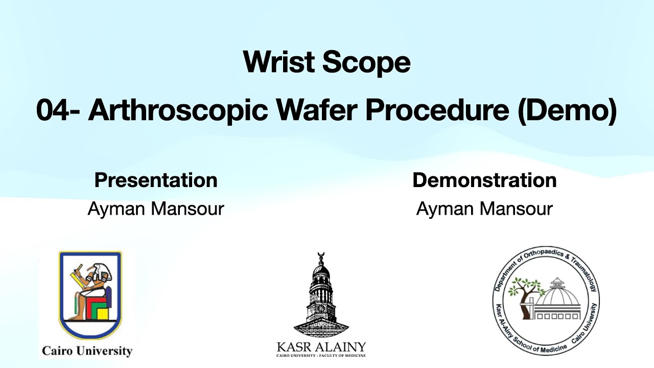 04 Arthroscopic Wafer Procedures - YouTube