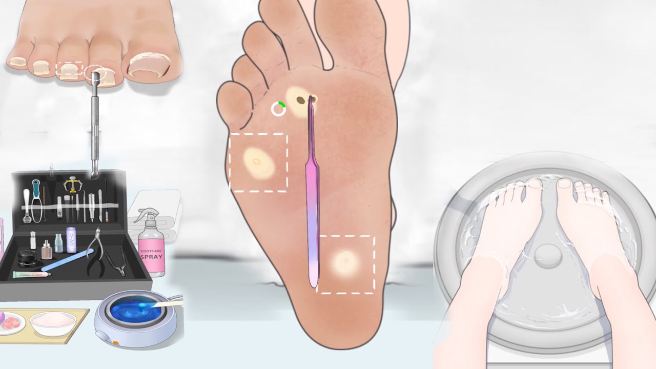 [ASMR] Remove thick dead Skin cells and | Foot Care Treatment Animation ...