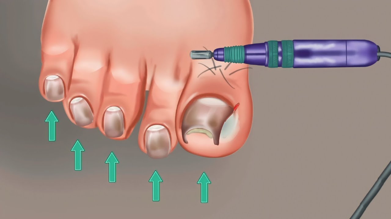 ASMR Eye discharge removal animation - Asmr hospital big acne extrusion ...
