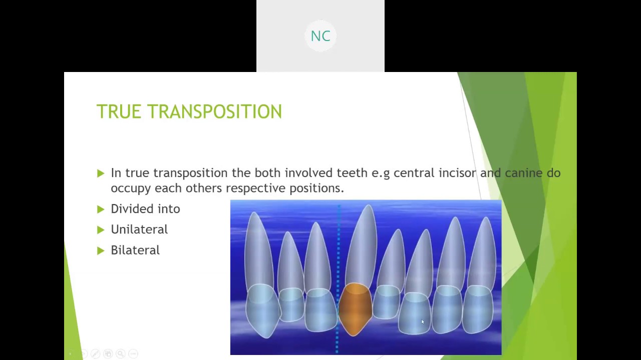 Orthodontic management of Ectopic tooth - YouTube