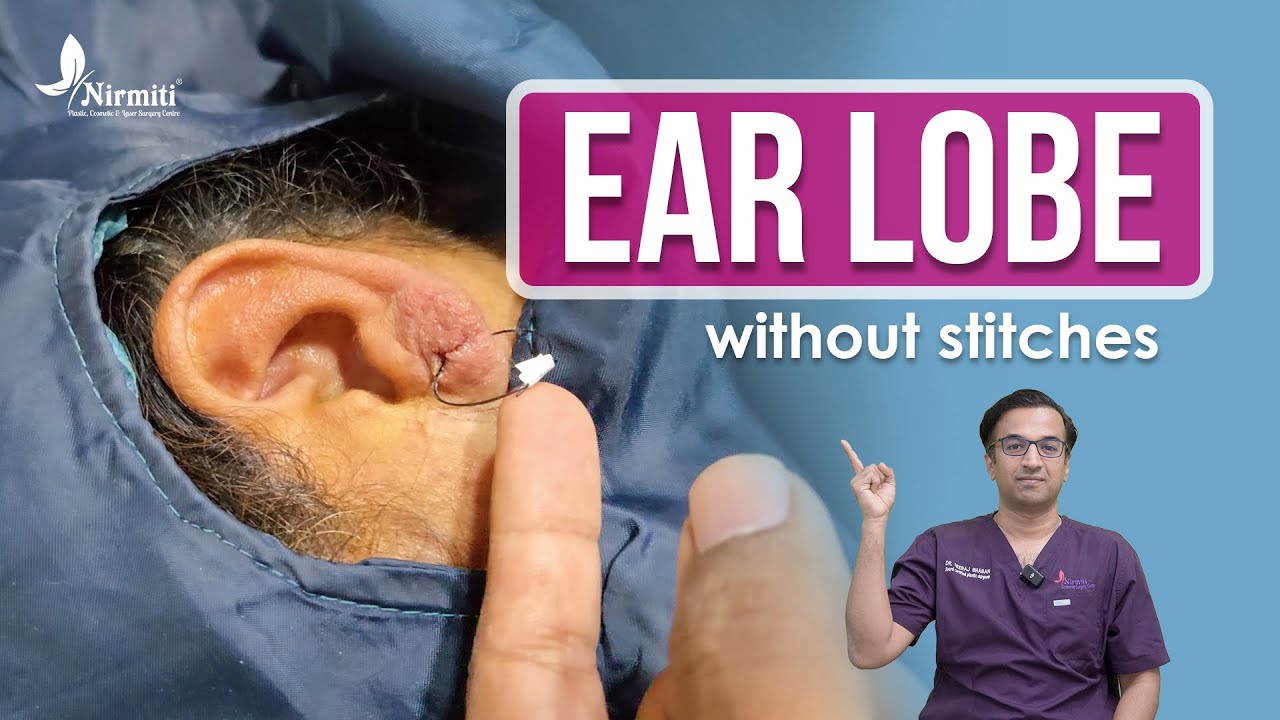 Ear Lobe Repair Treatment Without Stitch & Suture | Nirmiti Cosmetic ...