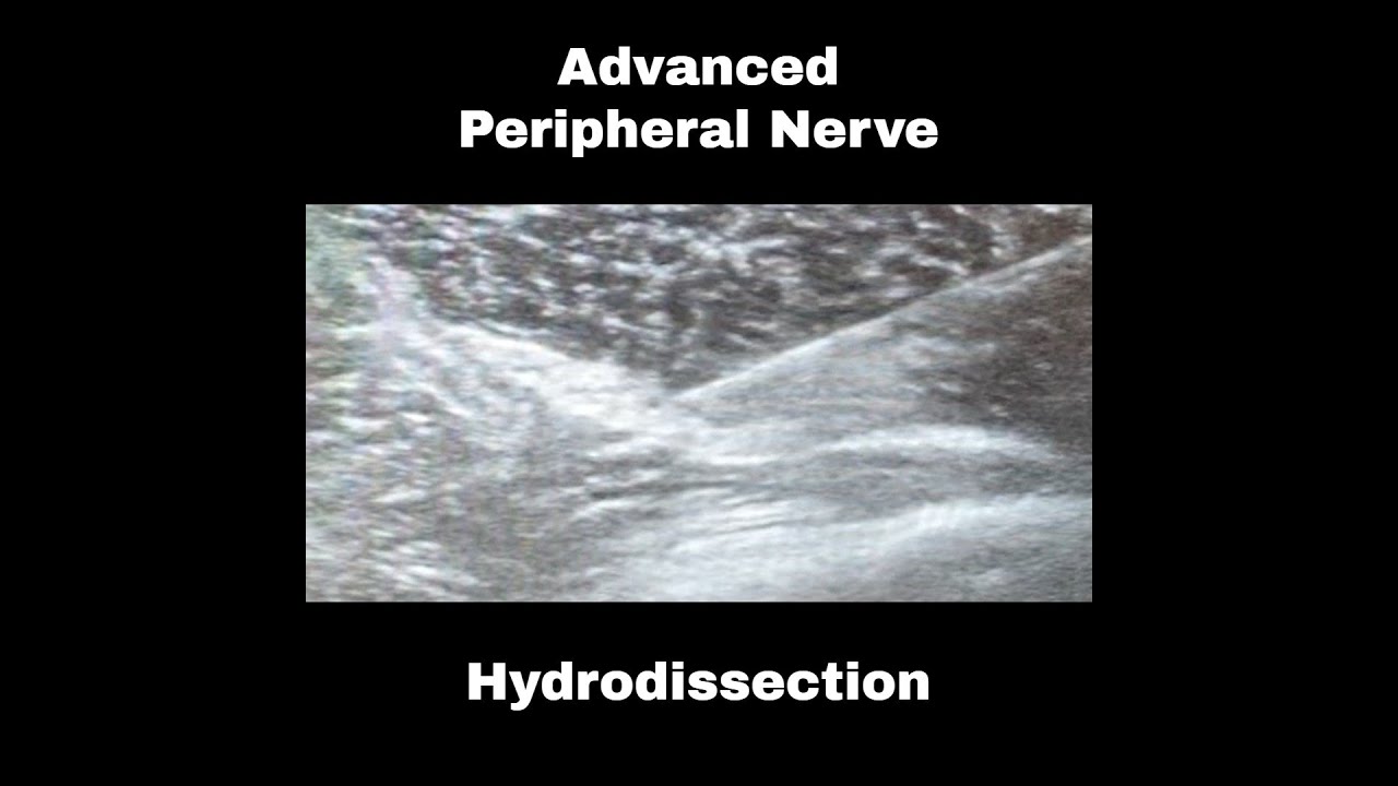 Non-Surgical Peripheral Nerve Treatment - Advanced Peripheral Nerve ...