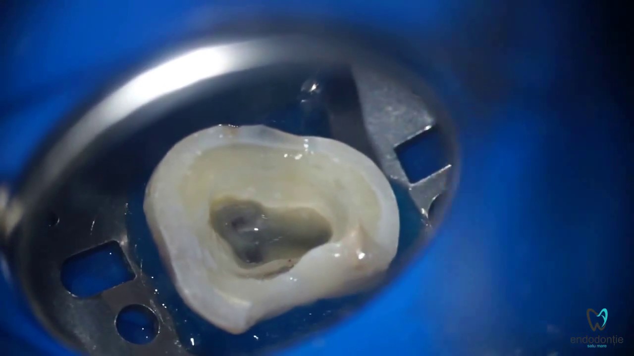 2.6 reciproc single file r25 - YouTube