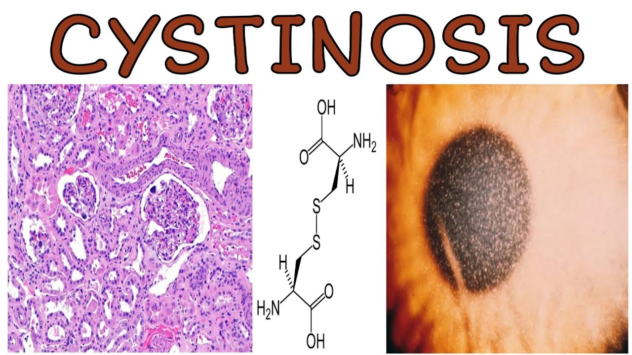 CYSTINOSIS | CAUSE | TYPES | DIAGNOSIS | TREATMENT | - YouTube