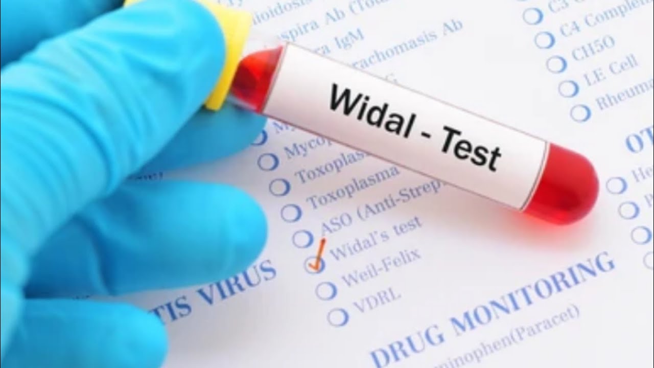 Widal Test All You Need T Know About Widal Test Procedure In English widal-test-all-you-need-t-know-about-widal-test-procedure-in-english