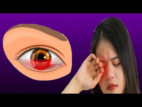 Sharp Eye Pain: Causes And Symptoms - YouTube