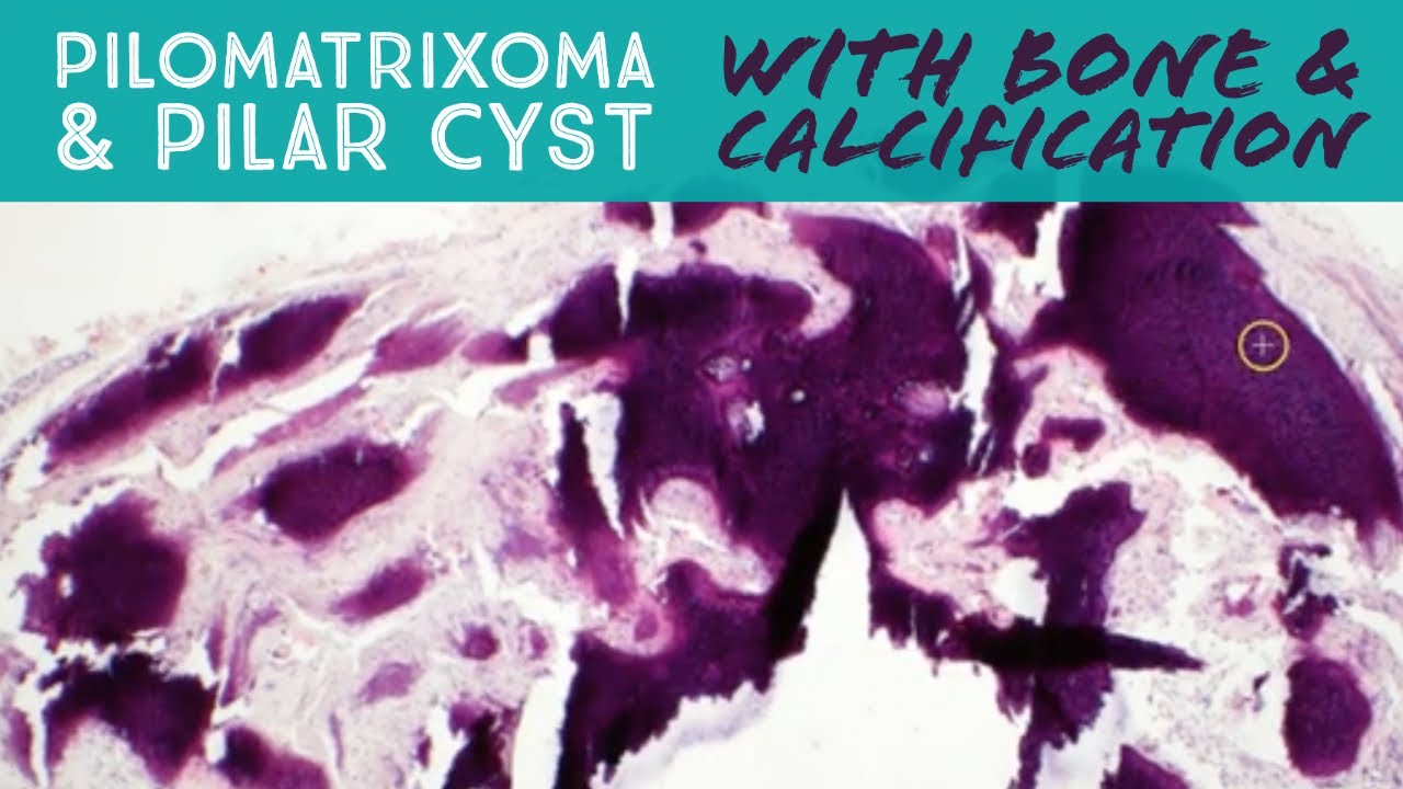 Bone in Skin??? Pilomatrixoma & Pilar Cyst with Calcification ...