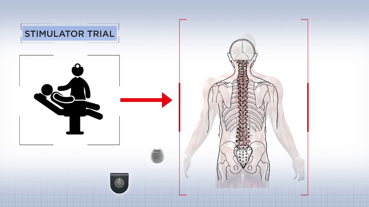 spinal cord stimulator animation - Physician Partners of America - YouTube