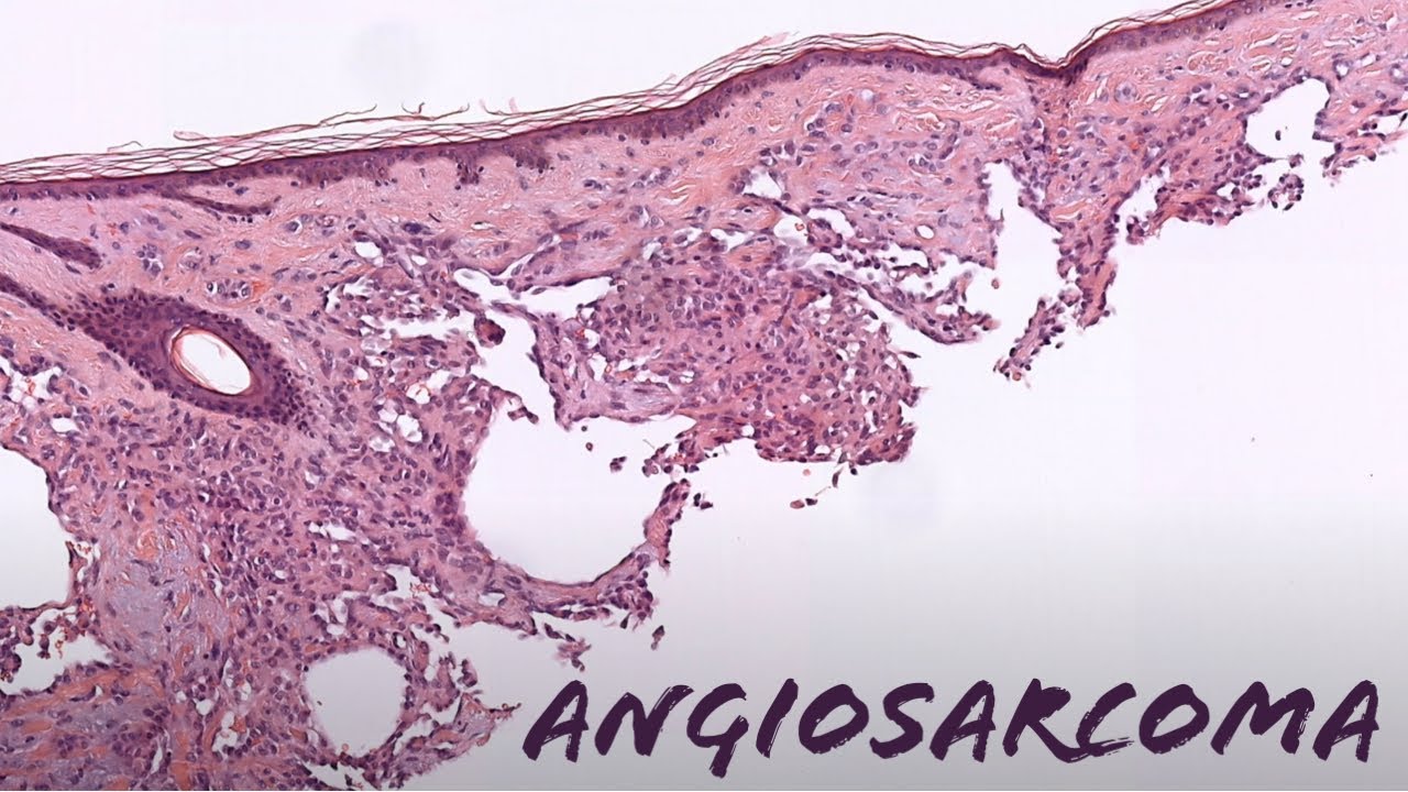 Angiosarcoma Histology