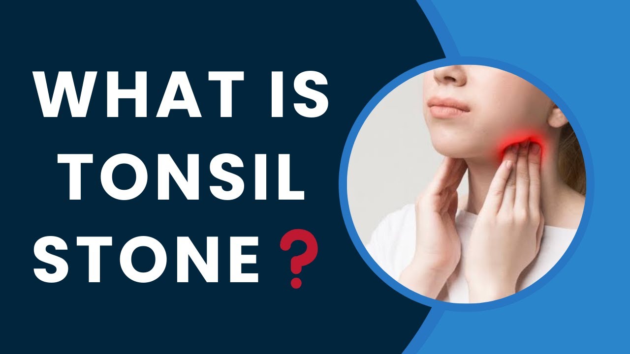 TONSIL STONE क्या होता है ? और इसकी परेशानियाँ| Tonsil stone |HOME ...