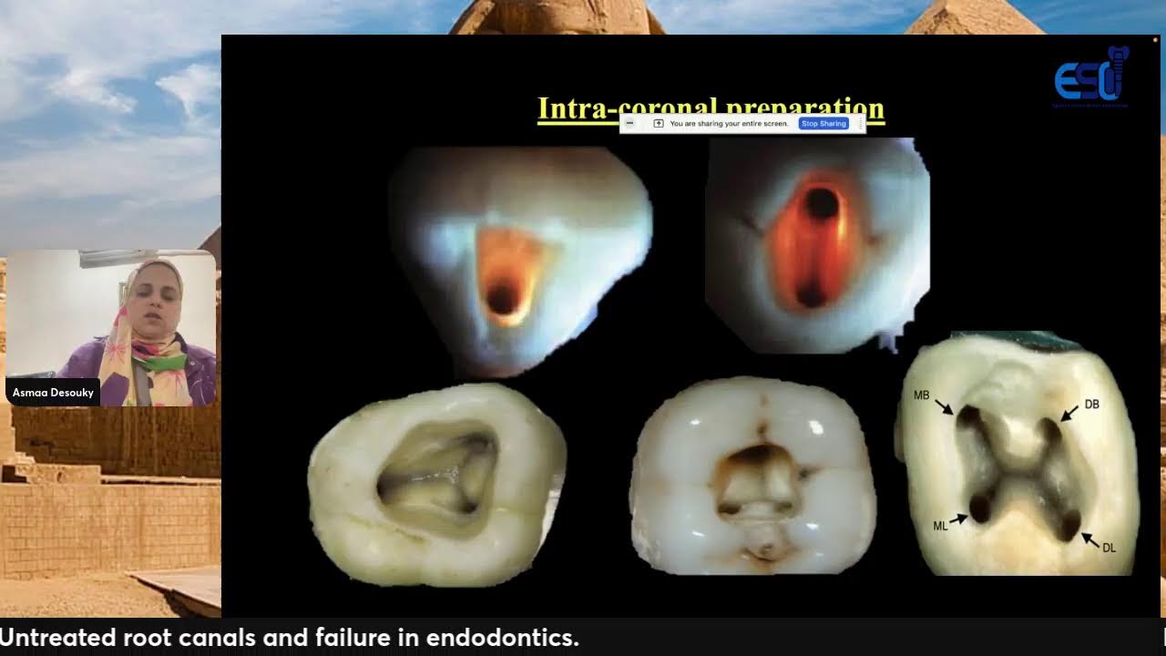 Dr. Asmaa Desouky - Untreated root canals and failure in endodontics ...