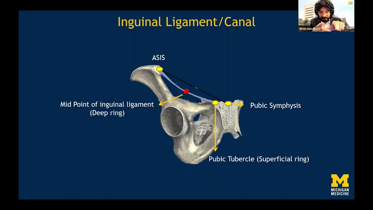 Ultrasound Diagnosis of Subtle Groin Hernia - YouTube